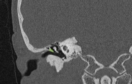 Scutum Temporal Bone