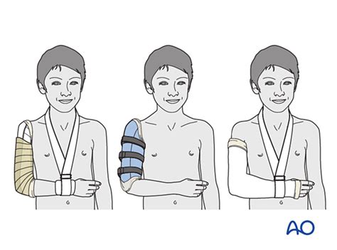 Immobilization With Splint Brace Or Cast For Multifragmentary