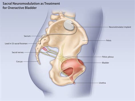 Sacral Neuromodulation For Overactive Bladder