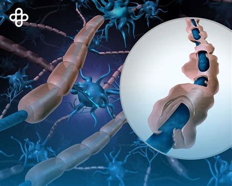 Causas De La Esclerosis Múltiple