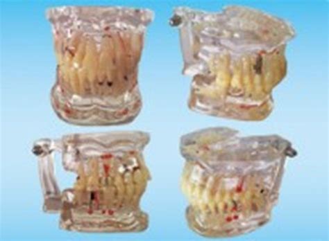 Implant Pathology Model Teeth Models Patient Education Demonstration