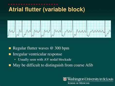 Ppt Telemetry Arrythmias Powerpoint Presentation Free Download