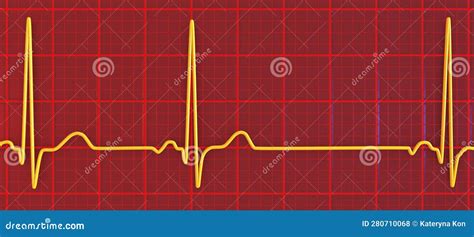 Electrocardiogram Ecg Displaying Sinus Arrhythmia 3d Illustration