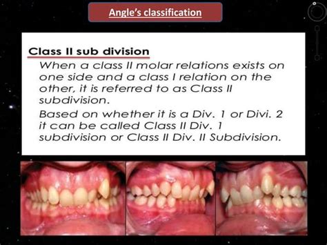 Class Ii Div 2 Malocclusion Pptx