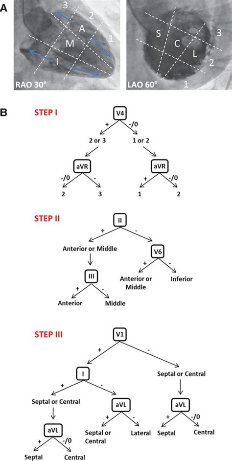 Twelve Lead Ecg Of Ventricular Tachycardia In Structural Heart Disease