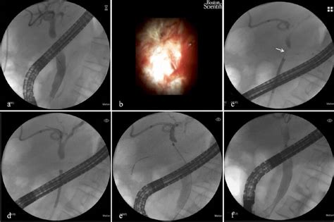 Spyglass Assisted Puncture Of The Complete Biliary Anastomotic