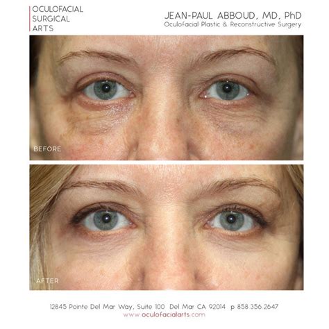 Eyelid Surgery Recovery In San Diego Healing Timeline For Upper