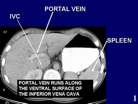 Portal Vein Ivc Medical Pictures Veins Vena