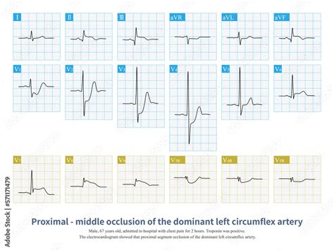 The Proximal Segment Occlusion Of The Dominant Left Circumflex Artery Can Lead To Multiple