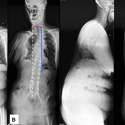 Coronal Consistency Pattern A A 67 Year Old Female With Coronal