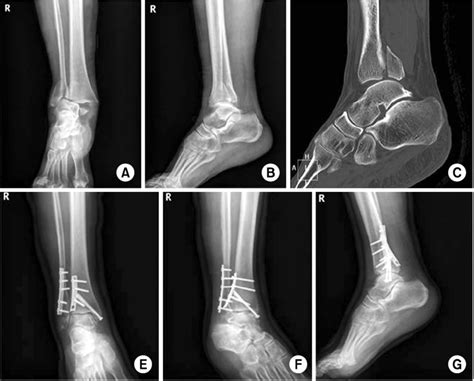 A B Anteroposterior And Lateral Radiographs Showing A Displaced