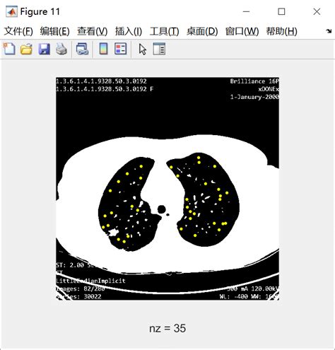 Github Cellmemichael Ct Images Of The Lungs Matlab