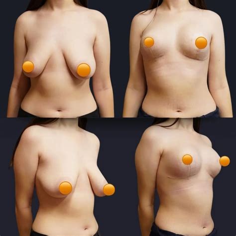 Breast Reduction Before And After Wix Clinic
