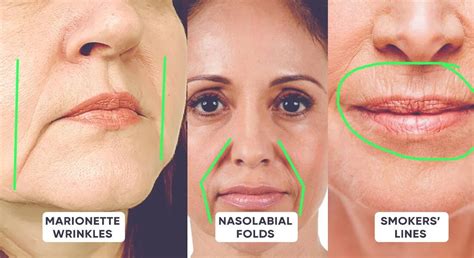 How To Get Rid Of Nasolabial Fold And Deep Smile Lines Best Treatment