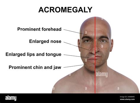 3d Illustration Comparing A Man With Acromegaly Left And The Same Healthy Man Right 3d Illustration Comparing A Man With Acromegaly Left And The Same Healthy Man Right