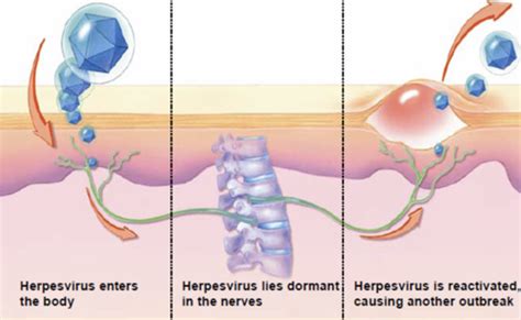 Herpes Simplex Virus Lecture 34 Flashcards Quizlet