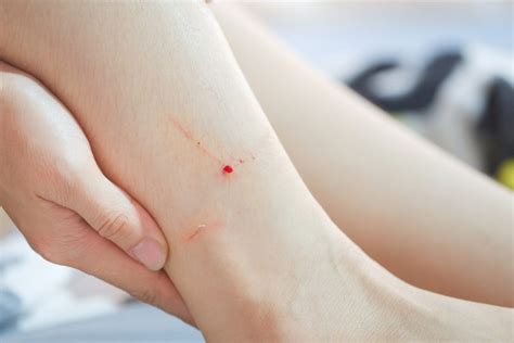 What To Do When A Cat Bites You Vet Reviewed Steps To Take Risks Catster