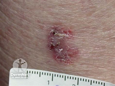 What Does Basal Cell Carcinoma Look Like