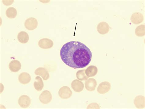 Bone Marrow Nonneoplastic Plasma Cells