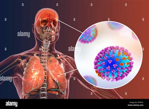 Computer Illustrations Showing The Common Complications Of Flu Infection Such As Encephalitis