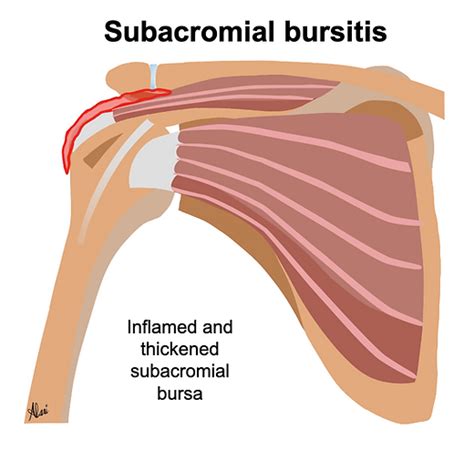 What Does A Cortisone Injection Do For Bursitis At Maddison Chapman Blog