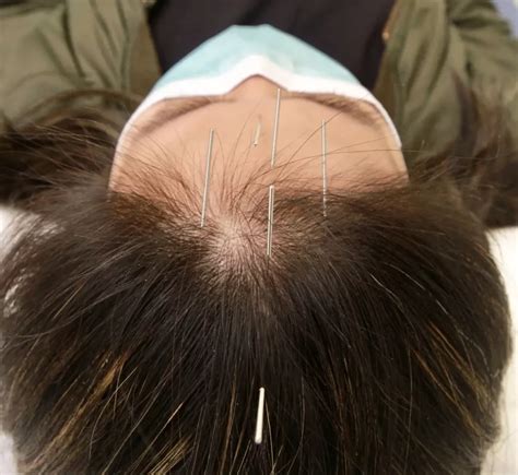 Scalp Acupuncture In Kuna Id Kuna Wellness And Acupuncture