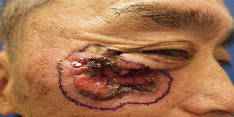 Malar Reconstruction With Anterior Bilobed Cheek Flap Plastic And