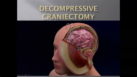 Decompressive Craniectomy For Head Injuries At Livasa Mohali