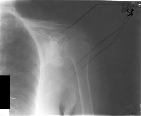 Pathology Outlines Calcium Pyrophosphate Crystal Deposition Disease