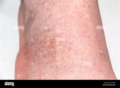 A Red Rash On The Foot Of A Male Against Background Closeup A Part Of