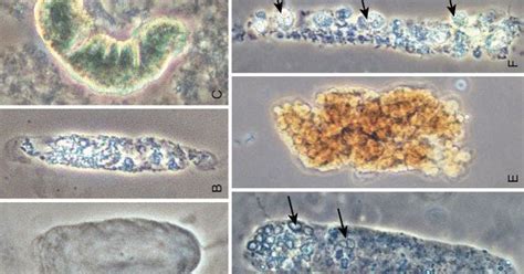 Medical Laboratory And Biomedical Science Urinary Casts