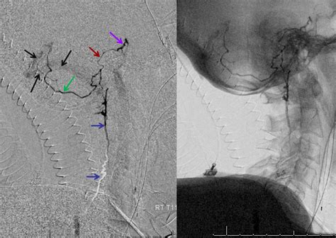 Spinal Venous Anatomy