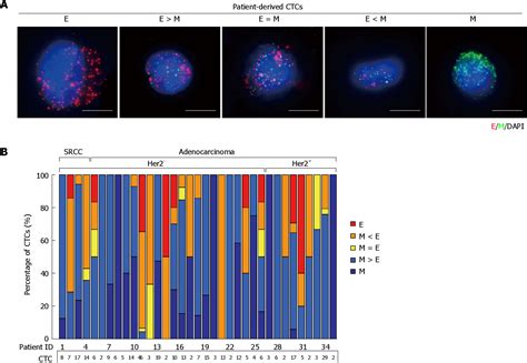 Figure 3 From Evaluation Of Epithelial Mesenchymal Transitioned Circulating Tumor Cells In