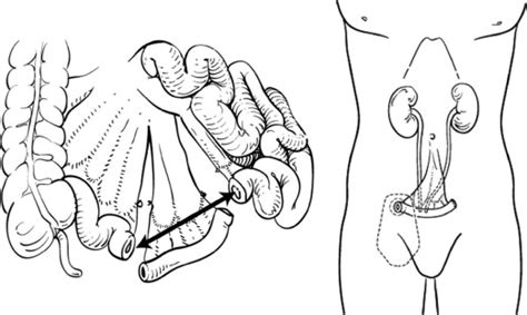 The Use Of Bowel In Urologic Reconstructive Surgery Surgical Clinics