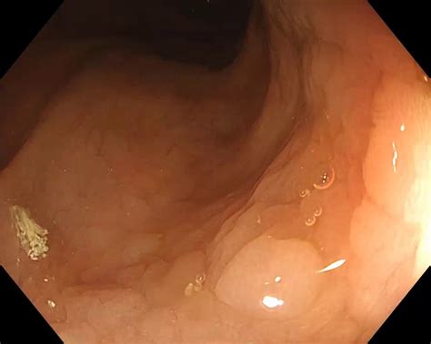 Hyperplastic Polyps Object Detection Dataset By Hmaid