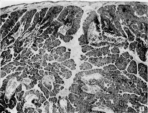 Figure 1 From The Tumor Response And Stroma Reaction Following X Ray Of