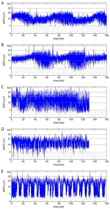 Characteristic Appearance Of Aeeg Tracings With Different Scores Of Download Scientific Diagram