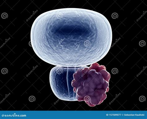 A Prostate Tumor Stock Illustration Illustration Of Prostate 157589077