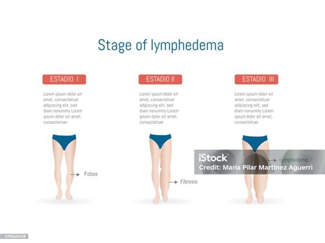 Stages Of Lymphedema Showing Leg Swelling Stock Illustration Download