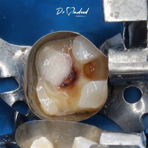 Mta Putty Pulp Capping Using Wellroot Putty Materials With Direct