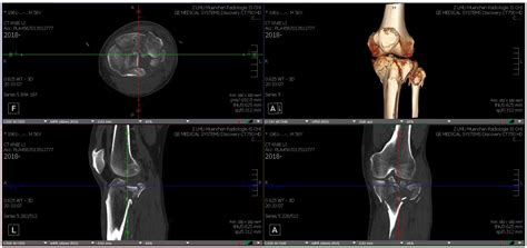 Preoperative Mixed Reality Visualization Of Complex Tibial Plateau Fractures And Its Benefit