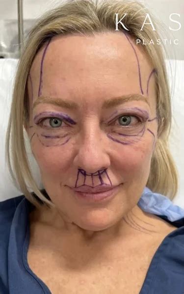 What Is Nasal Septal Deviation Or “deviated Septum” Kassir Plastic Surgery