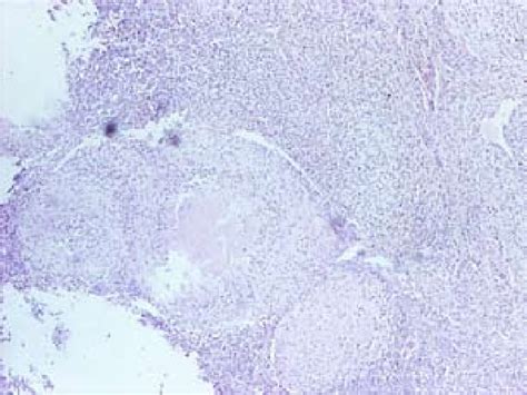 Histopathological Features Of Tuberculous Lymphadenitis Hematoxylin Download Scientific