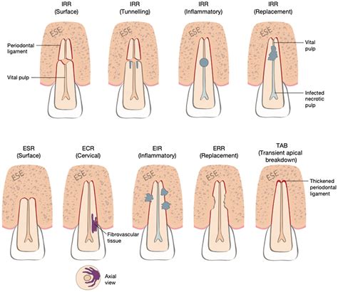 Tooth Resorption Part I Pathogenesis And Case Series Of Multiple