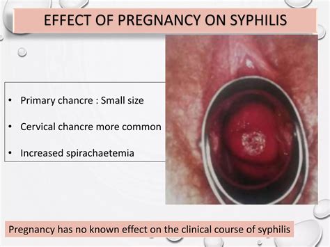Sexually Transmitted Infections In Pregnancy Pptx