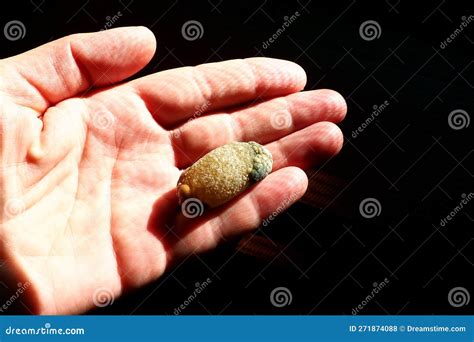 Gallstone Disease Cholelithiasis The Formation Of Stones Stones In