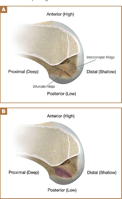 Figure 4 From Rationale For Strategic Graft Placement In Anterior