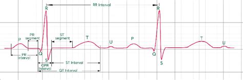 Figure 1 From Ecg Arrhythmia Classification Using Ensemble Of Features Semantic Scholar