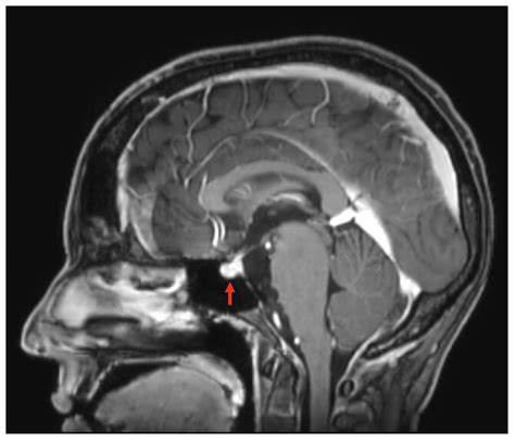 Pituitary Tumor