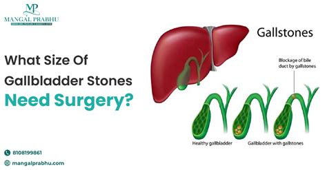 Gallstones In Gallbladder Gallstones In Gallbladder